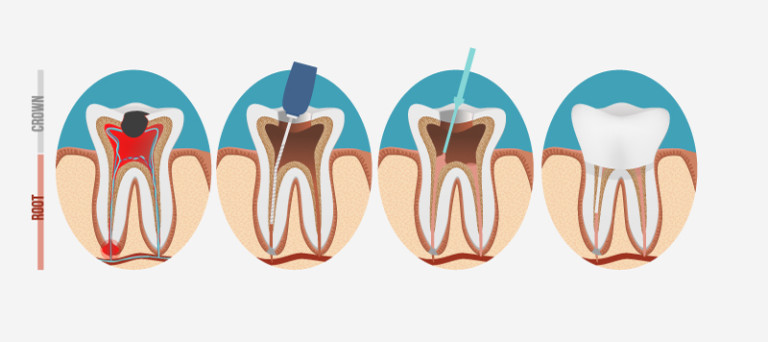 Root canal procedure. - Aurora Yonge Dental